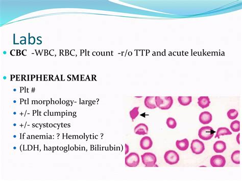 Thrombocytopenia Ppsx