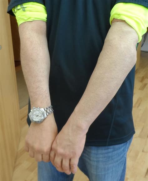 Passive Prosthetic Arm Orthotics And Prosthetics Prosthetics Hand