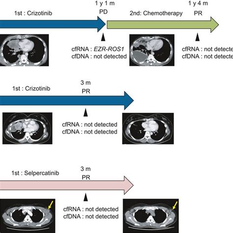 Fusion Detection Sensitivities Of The Cfrna‐based And Cfdna‐based