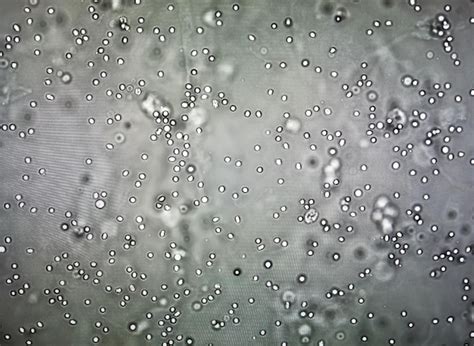 Premium Photo Budding Yeast Cells In Patient Urine Urinary Tract Infections Pyelonephritis Or