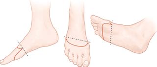 Transmetatarsal Amputation New Health Advisor