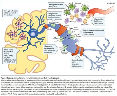 Understanding Multiple Sclerosis 👏 Lucia Julia Salgueiro