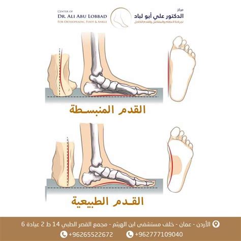 وحدة جراحة القدم والكاحل تبسط القدم فلات فوت المكتسب عند الكبار