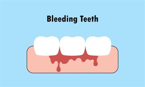 Premium Vector Bleeding White Teeth While Cleaning Because Brushing