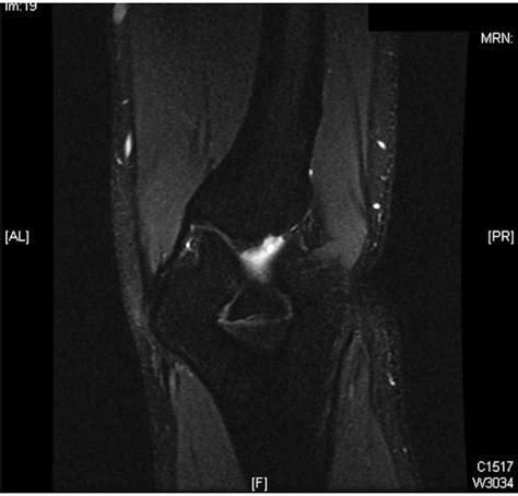Prp For Partial Ucl Tears Sports Medicine Review