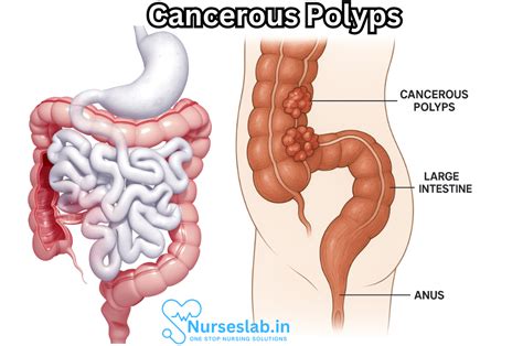 Cancerous Polyps Nurseslab