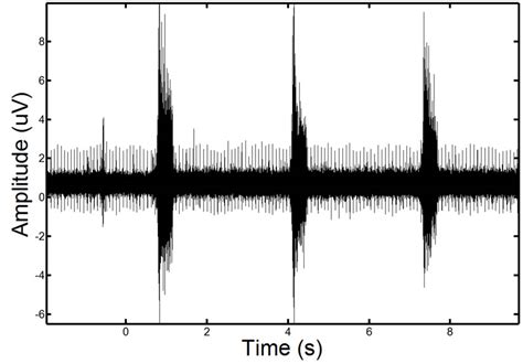 Local Wavelet Based Filtering Of Electromyographic Signals To Eliminate The Electrocardiographic
