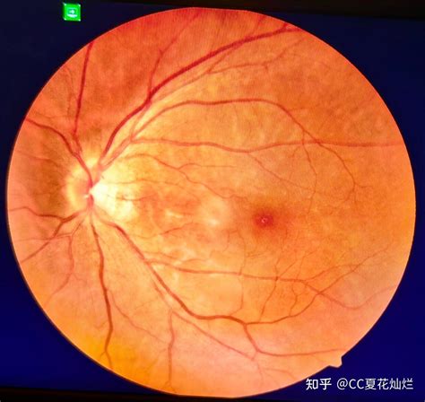 【从眼底可以看出什么疾病？】 知乎