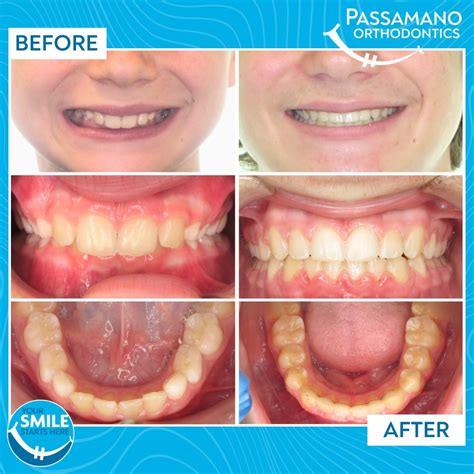 Deep Bite And Class 2 Retrusive Jaw Fixed With Braces Passamano Orthodontics