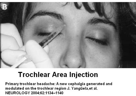 Quick Fix For Headaches Repeated Nerve Supraorbital Infraorbital And Occipital Nerve Blocks