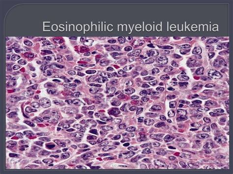 Eosinophils In Lymph Node