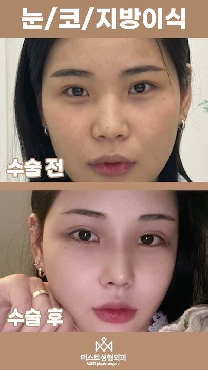 머스트 성형외과 듀얼트임 매부리코 복코 지방이식 성형 전후 Shorts Youtube