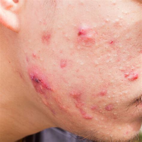 Steroids For Face Acne At Mary Cobbs Blog