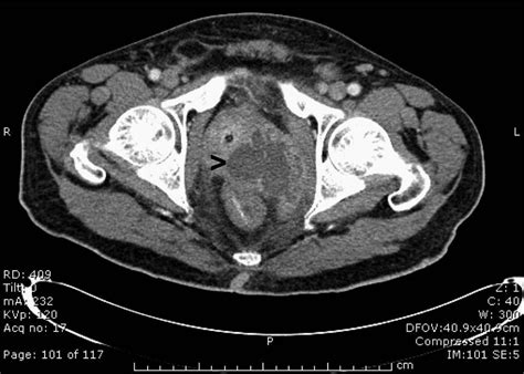 Prostatitis Or Prostatic Abscess Journal Of Emergency Medicine