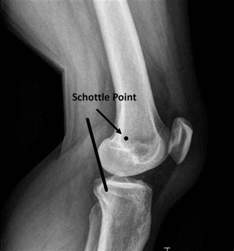Figure Schottle Point Contributed By Ahmed Mabrouk Statpearls