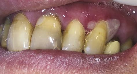 Pemphigoïde Bulleuse Orale La Revue Du Praticien