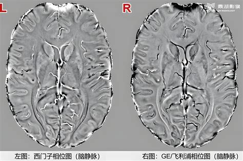 Swi磁共振磁敏感加权成像图像判读法则 鼎湖影像