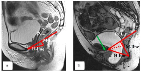 Diagnostic Value Of Dynamic Magnetic Resonance Imaging Dmri Of The