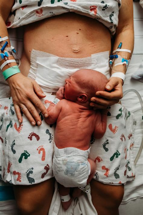 C Section Shelf What It Is And How To Get Rid Of It