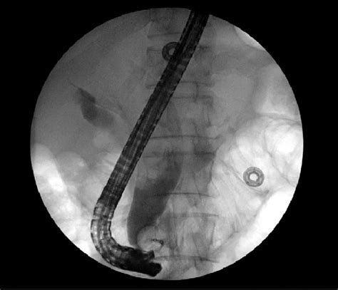 Ercp Showed Severely Dilated Cbd Download Scientific Diagram