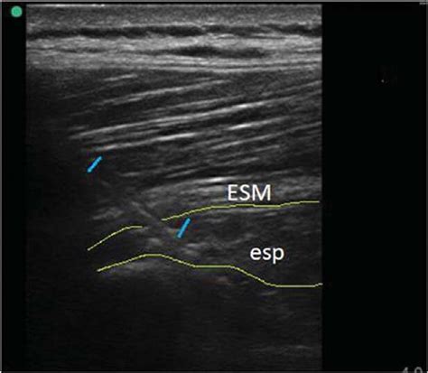 Blue Lines Needle Placement Esm Erector Spinae Muscle Esp Erector Download Scientific