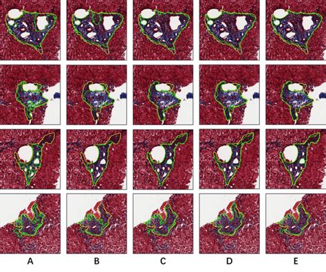 qualitative comparison of ablated models for liver portal tract