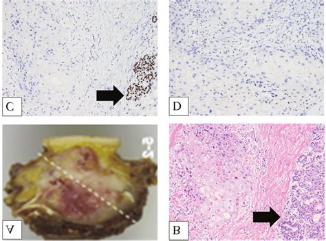 Images From The Resected Parotid Tumor A The Surgical Specimen B Download Scientific