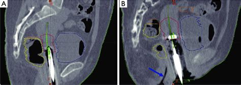 Rectal Volume Before And After Insertion Of A Catheter A The Rectal