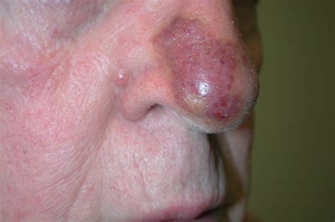 What Is Angiosarcoma Symptoms Diagnosis And Treatment