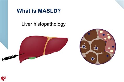 Portal Hypertension A Systemic Disease E Gallery University Of