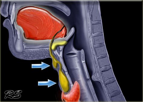 The Radiology Assistant Infrahyoid Neck The Radiology Assistant Infrahyoid Neck