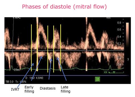 Phases Of Diastole Mitral Flow Color And Spectral Doppler Diagram