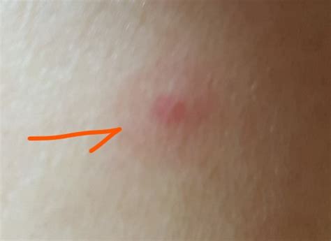 진드기물린증상과 자국 상처 나만의 프로토콜