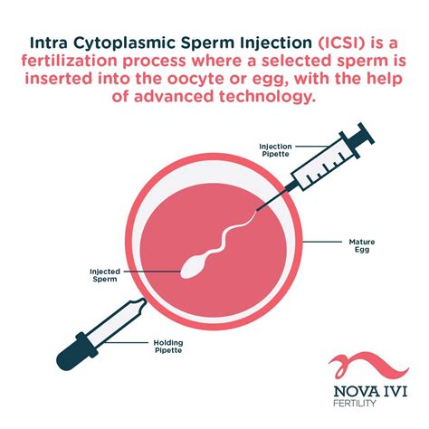 Nova Ivf Fertility On Linkedin Intra Cytoplasmic Sperm Injection Or Icsi Is An Advanced