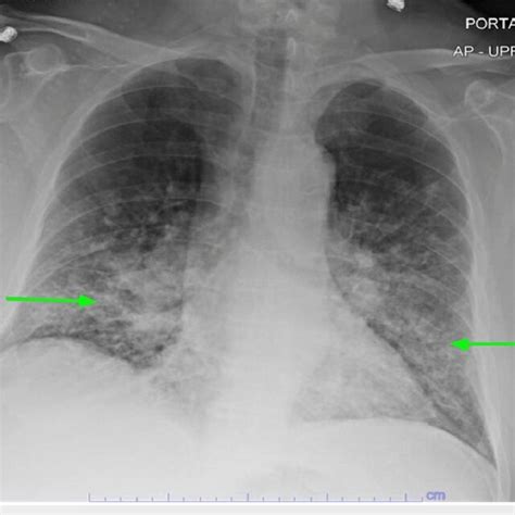 Cxr Showed Increased Patchy Airspace Disease Throughout The Mid And Download Scientific Diagram