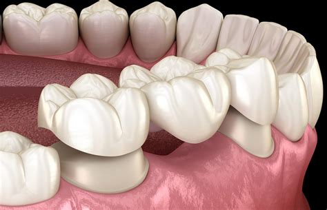 Dental Bridges Dr Soto The Downey Dentist