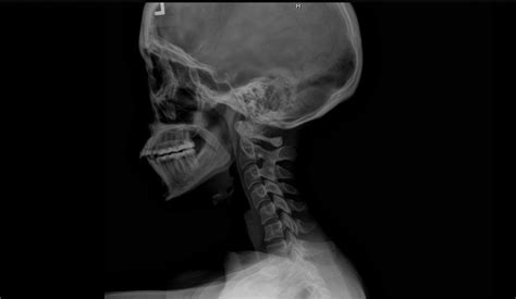 Can A Chiropractor Help Occipital Neuralgia Ascent Chiropractic