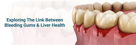 The Surprising Link Explore Bleeding Gums And Liver Health