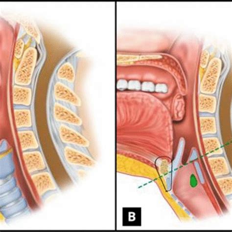 A Model Of Anatomical Outcome After Open Partial Horizontal Download Scientific Diagram