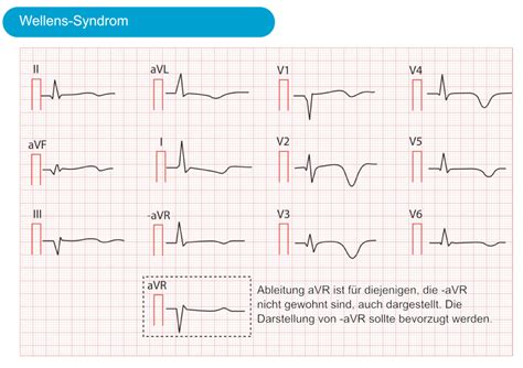 T Wellen Bei Ischämie Hyperakut Invertiert Negativ Wellens Syndrom