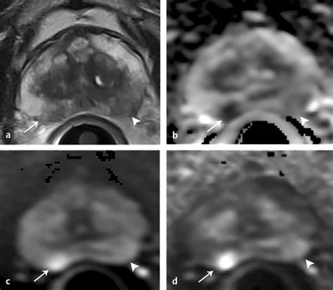Diffusion Weighted Imaging Of The Prostate Radiology Key