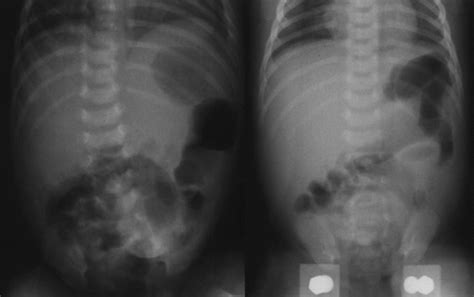 Radiology In Ped Emerg Med Vol 3 Case 18
