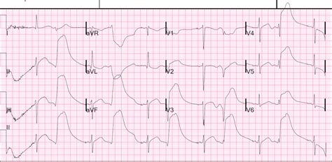 Long Qt Syndrome With Continuously Recurrent Polymorphic Vt Management