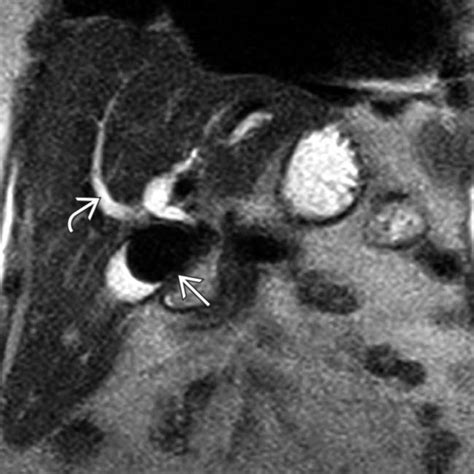 Mirizzi Syndrome Radiology Key