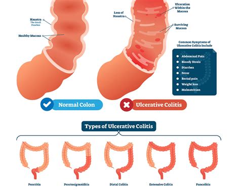 Ulcerative Colitis Dr Neeraj Singh Md Facs Fascrs