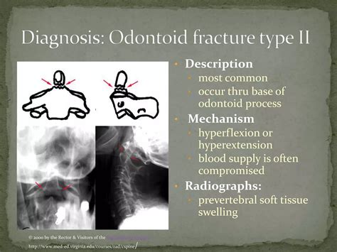Odontoid Fractures Pptx
