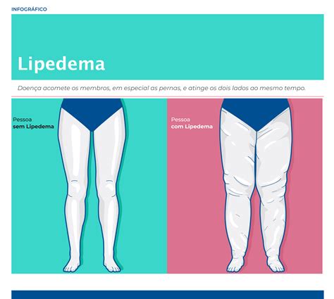 Lipedema Identificando Os Primeiros Sinais E Sintomas Dr Fernando