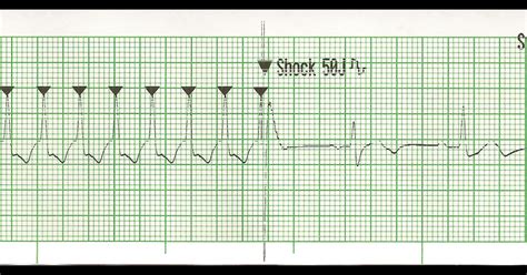 Float Nurse ACLS Review SVT Part