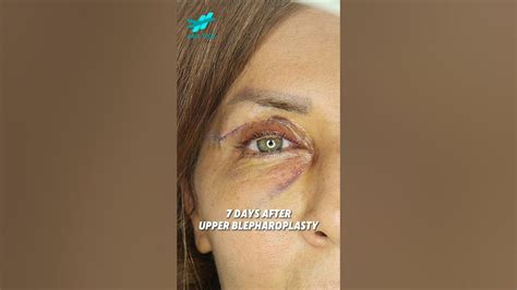 7 Days After Blepharoplasty Upper Eyelids Youtube