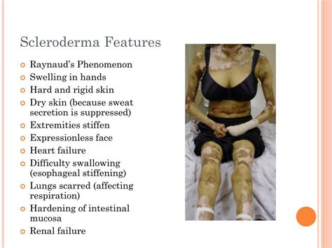 Ppt Connective Tissue Disorders Powerpoint Presentation Free Download Id 5517760